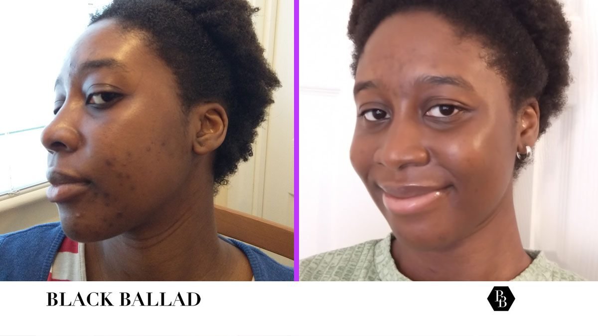 Dealing With The Physical & Emotional Effects Of Acne As A Dark-Skinned ...